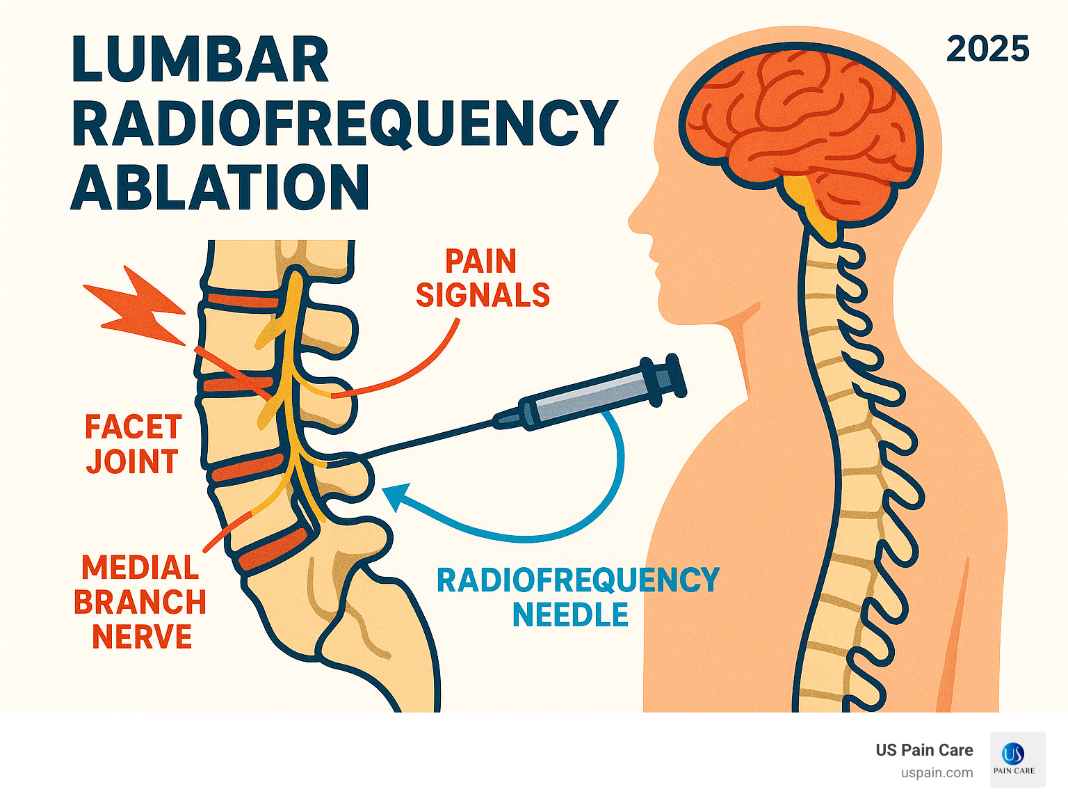 Lumbar Radiofrequency Ablation: Top 3 Proven Benefits 2025
