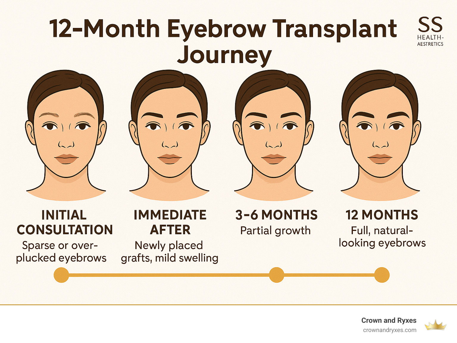 Hair Transplant Eyebrows Before After: 12-Month Flawless Results