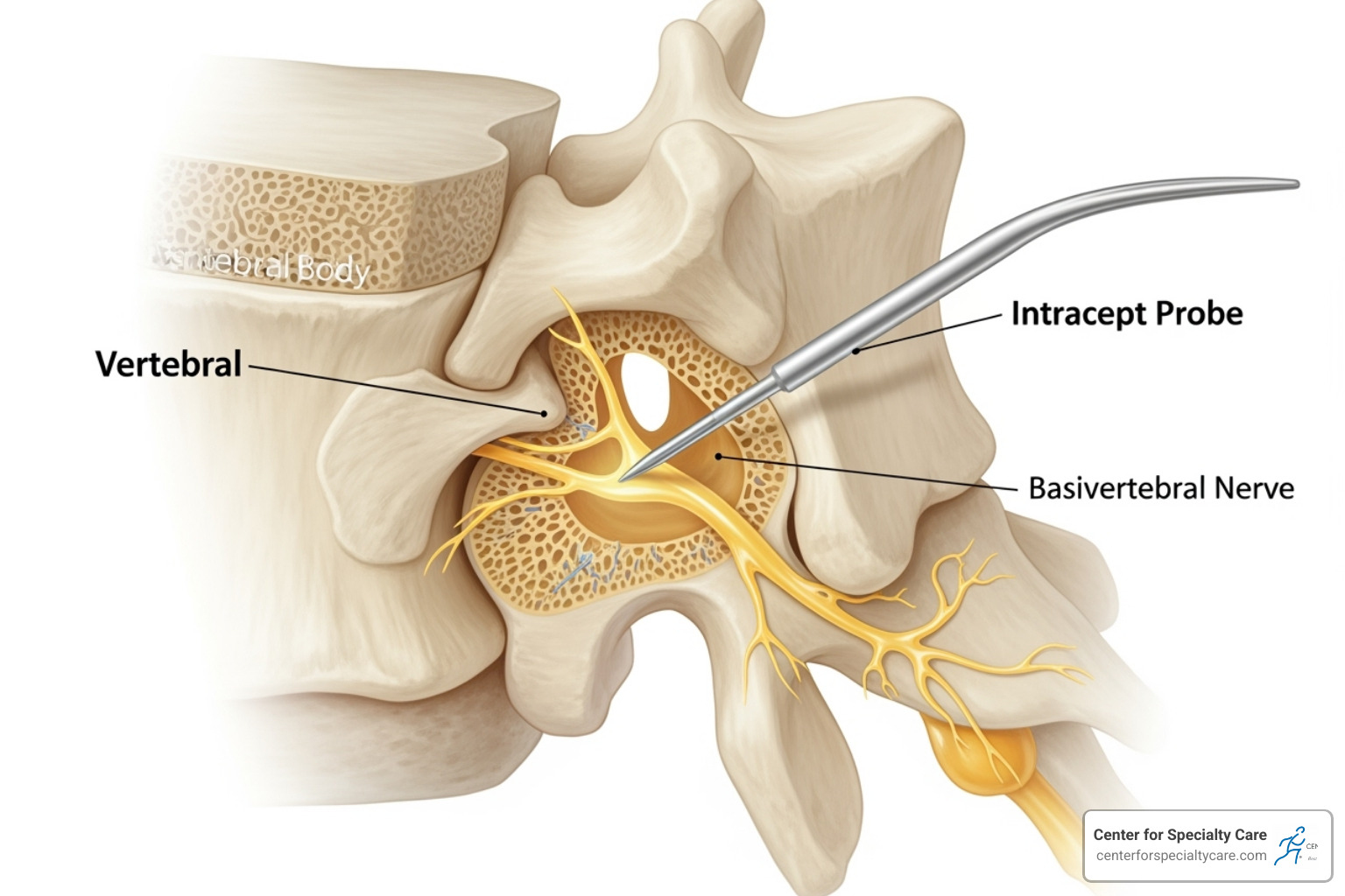 Does Medicare Cover Intracept Procedure: Key 2 Relief