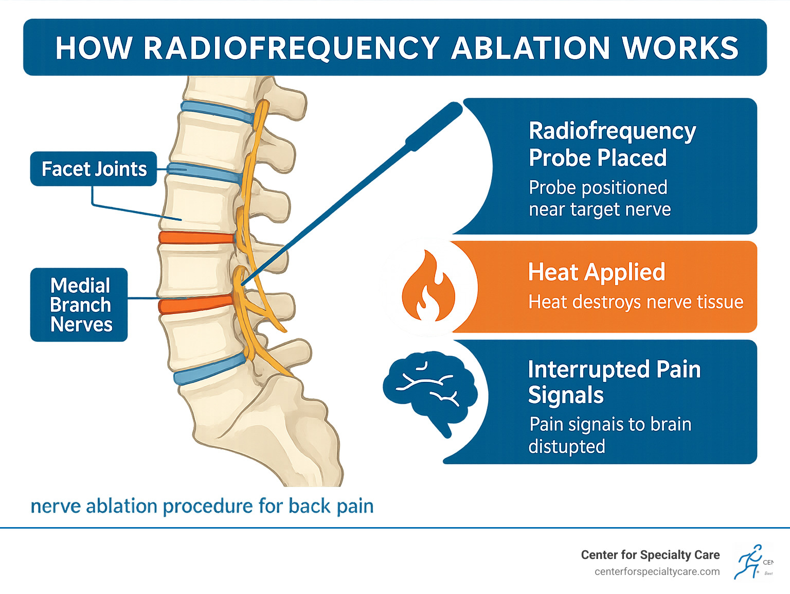 Nerve ablation procedure for back pain: Maximize Relief 2025