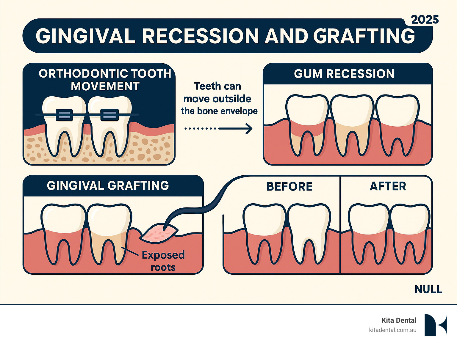 Gingival recession and grafting: Gingival recession caused by ...