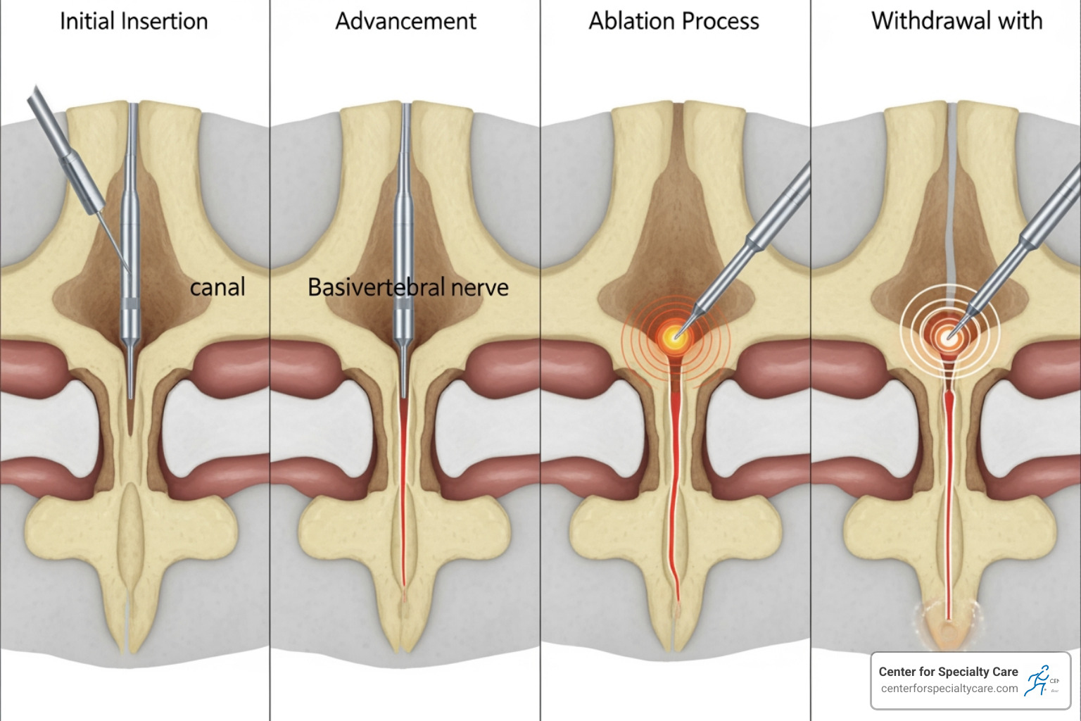 Intracept Procedure Spine: 5+ Years of Proven Relief