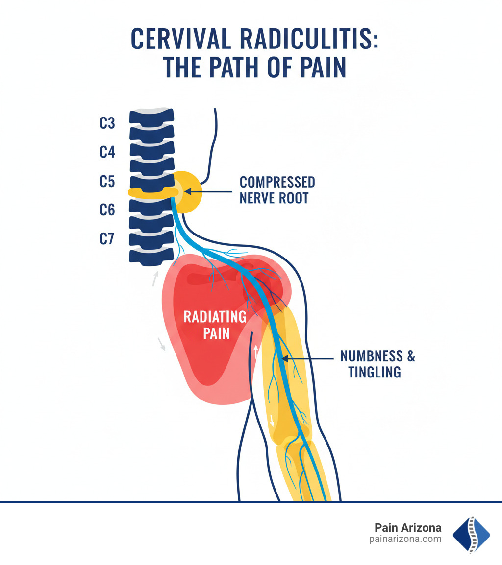 Cervical radiculitis treatment: Proven 1st Relief